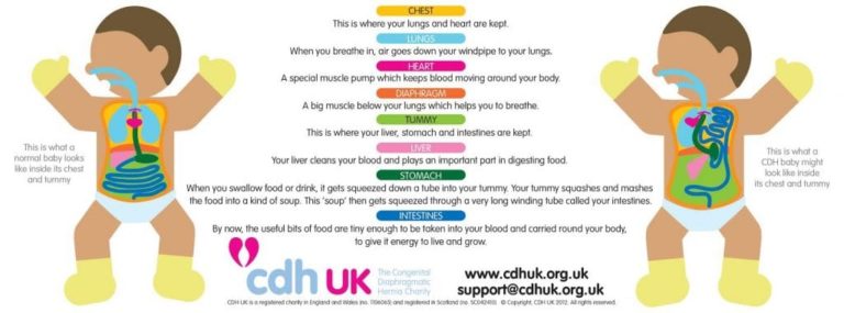 What is CDH? - CDH UK