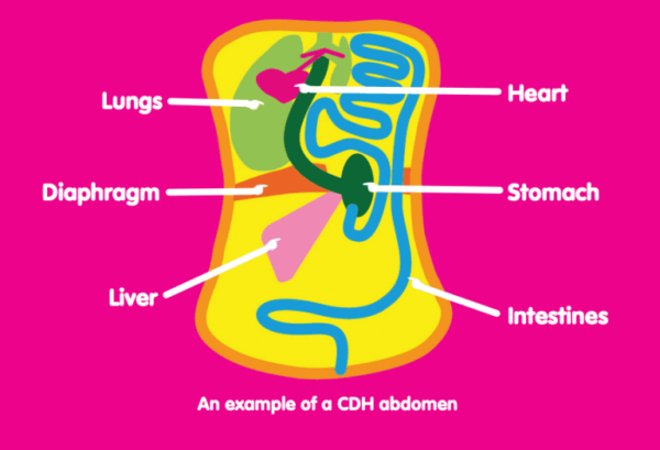 How Is CDH Diagnosed? - CDH UK